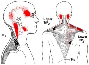 The Definitive Guide to Upper Trapezius Anatomy, Exercises & Rehab
